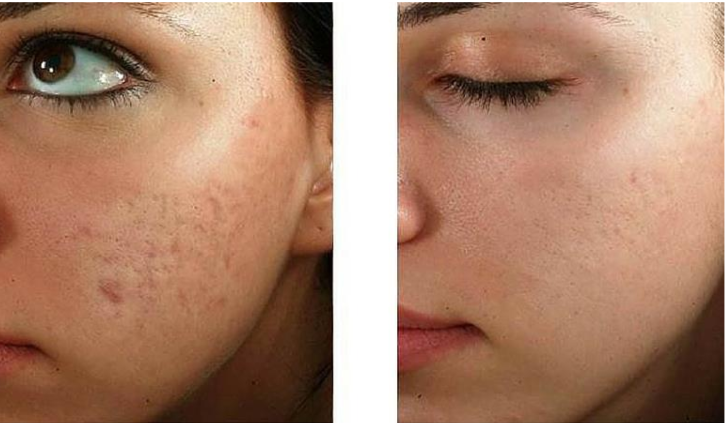 Bianca´s Kosmetikstudio - Microneedling